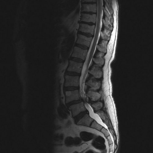 Abbas Spince Surgery | Spinal Stenosis